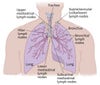 Non-small Cell Lung Cancer Stages | American Cancer Society