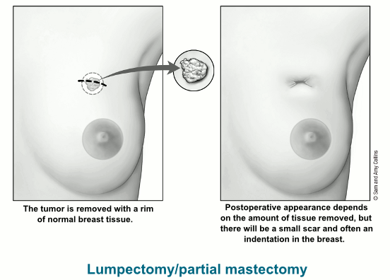 Breast-conserving Surgery (Lumpectomy) | Treating Breast Cancer ...