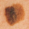 How to Spot Skin Cancer | American Cancer Society