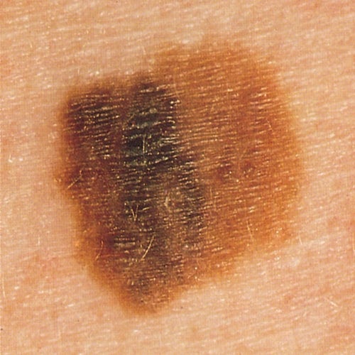 How to Spot Skin Cancer | American Cancer Society