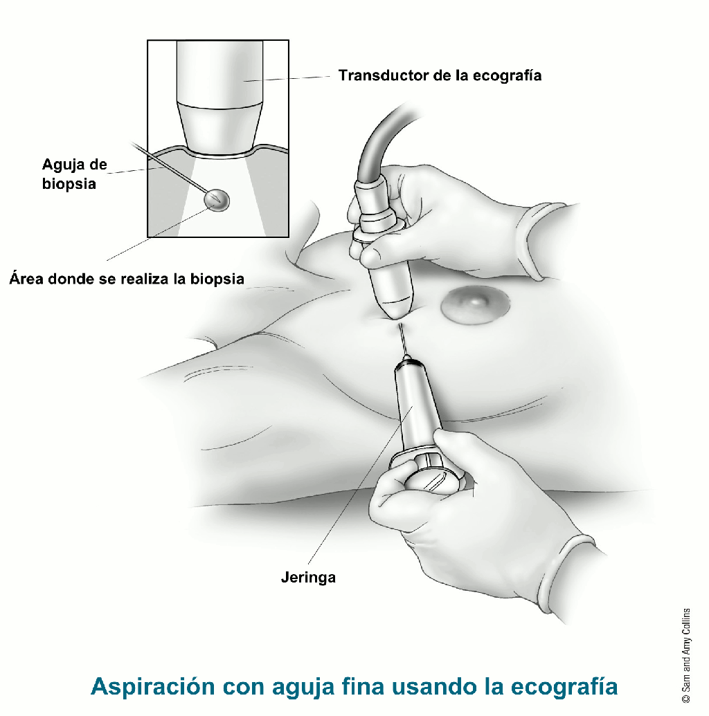 Biopsia por aspiración con aguja fina | American Cancer Society