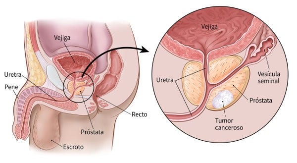 Pruebas De Detección Para El Cáncer De Próstata