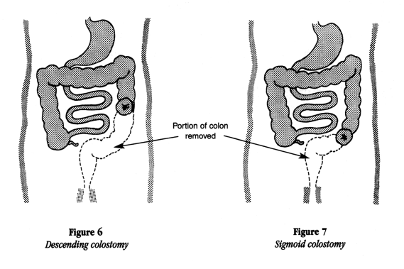Colostomy Types | American Cancer Society