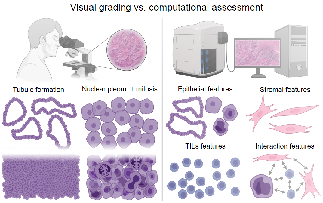 New AI Tool Improves the Accuracy of a Breast Cancer Prognosis ... New AI Tool Improves the Accuracy of a Breast Cancer Prognosis ...
