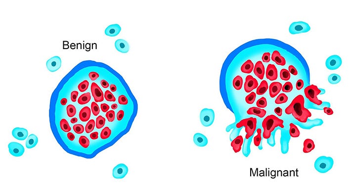 What Are Neoplasms and Tumors? | American Cancer Society