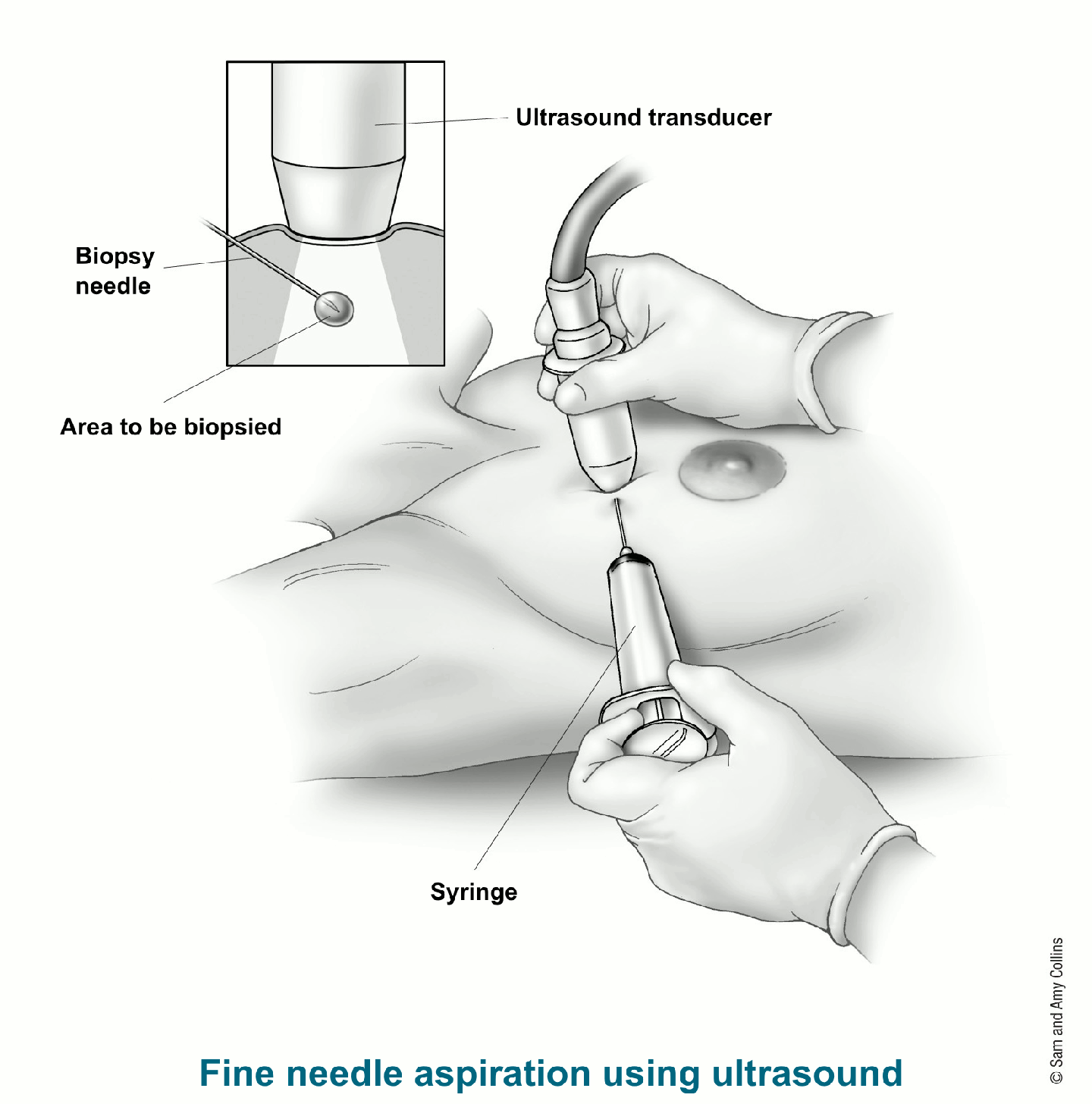 Fine Needle Aspiration (FNA) of the Breast | American Cancer Society