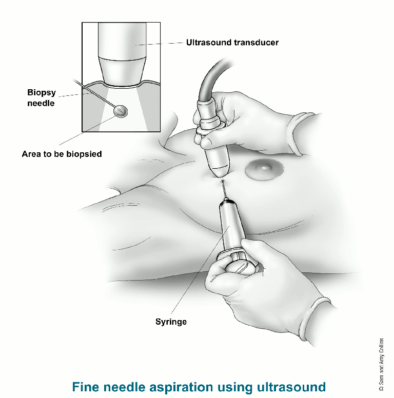 Fine Needle Aspiration (FNA) of the Breast | American Cancer Society