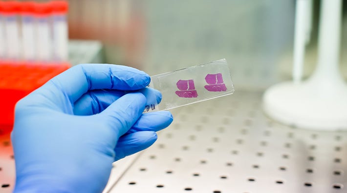 Can Getting a Biopsy Make Cancer Spread? | American Cancer Society