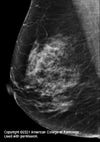 Dense Breast Tissue | Breast Density and Mammogram Reports | American ...