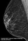 Dense Breast Tissue | Breast Density and Mammogram Reports | American ...