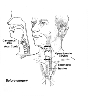 Throat Cancer Surgery | What is Surgery for Throat Cancer? | American ...