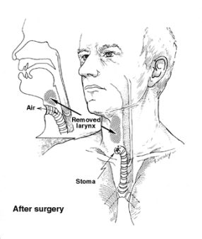 Surgery for Oral (Mouth) and Oropharyngeal (Throat) Cancer | American ...