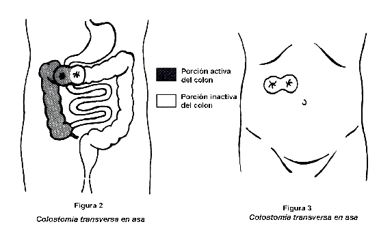 Tipos de colostomías y sistemas de bolsa recolectora | American Cancer ...