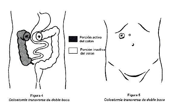 Tipos de colostomías y sistemas de bolsa recolectora | American Cancer ...