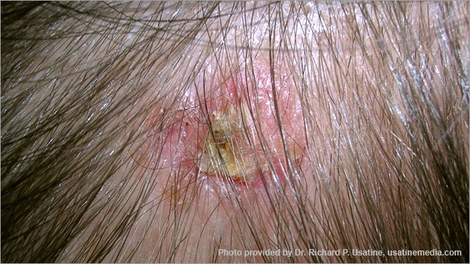 Cancerous Moles On Scalp