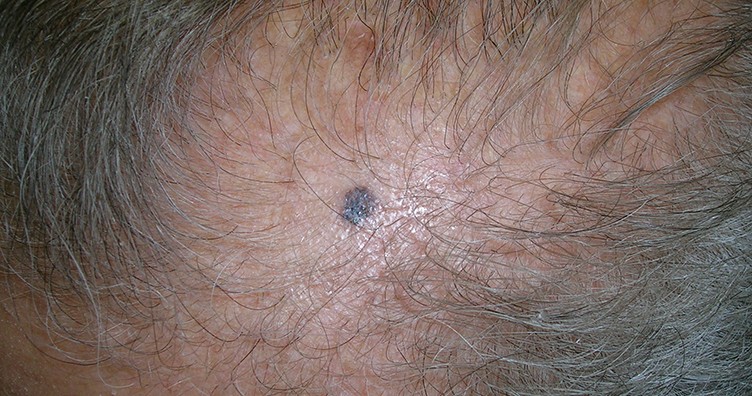Skin Cancer On Face White Spot