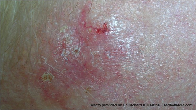 Perianal Skin Cancer