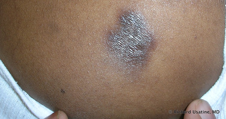 Mancha Negra Plana En La Piel Melanoma Cutáneo ScienceDirect