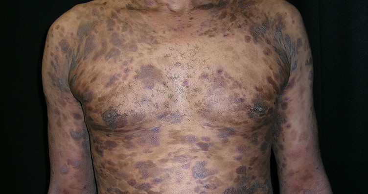Cancerous Lumps On Back