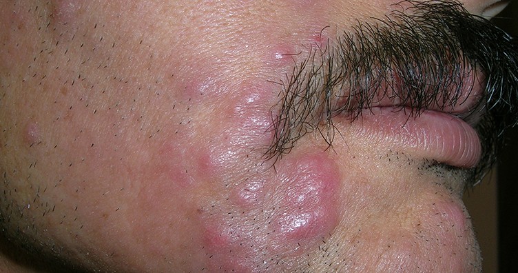 Skin Cancer On Face Looks Like Pimple