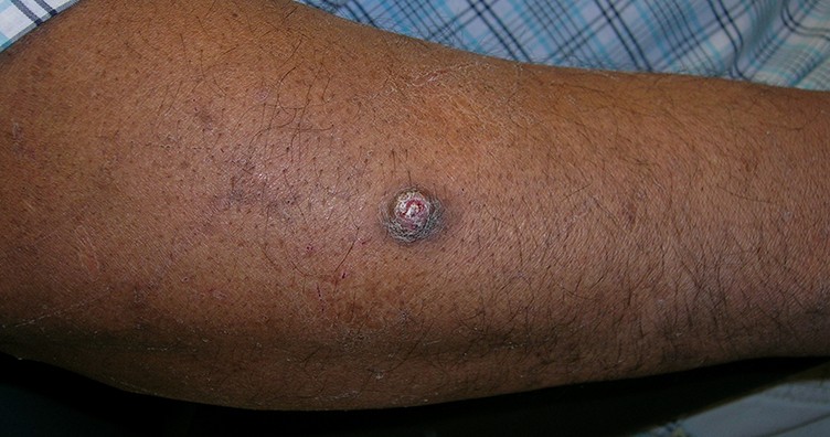 Skin Cancer On Forearm