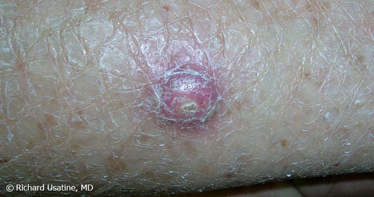 Skin Cancer Early Stages