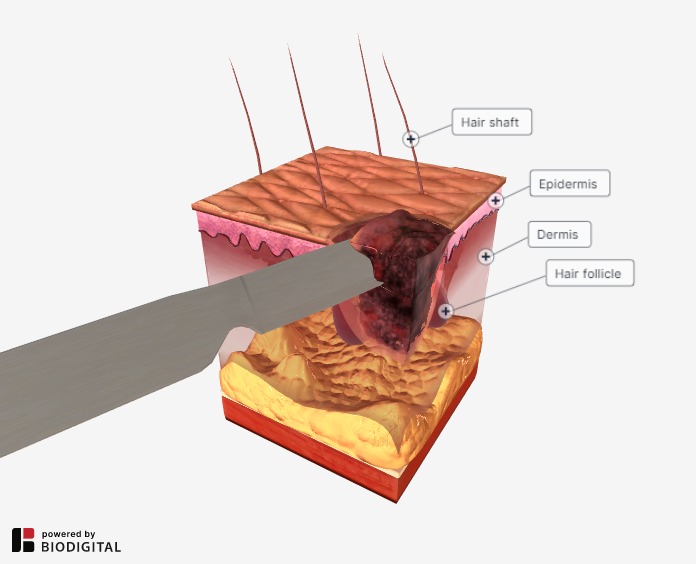 Skin Biopsy and Treatment Procedures | American Cancer Society