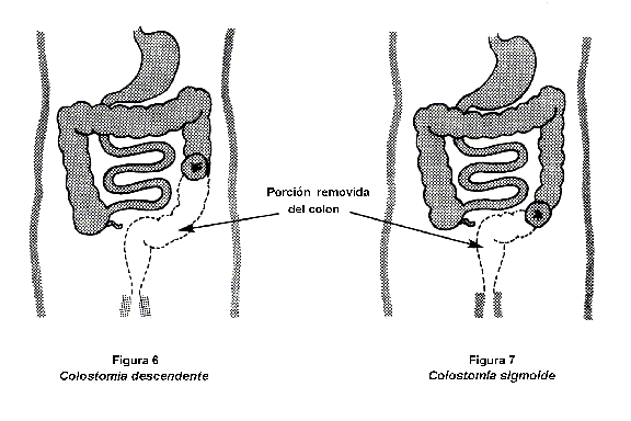 Tipos de colostomías y sistemas de bolsa recolectora | American Cancer ...
